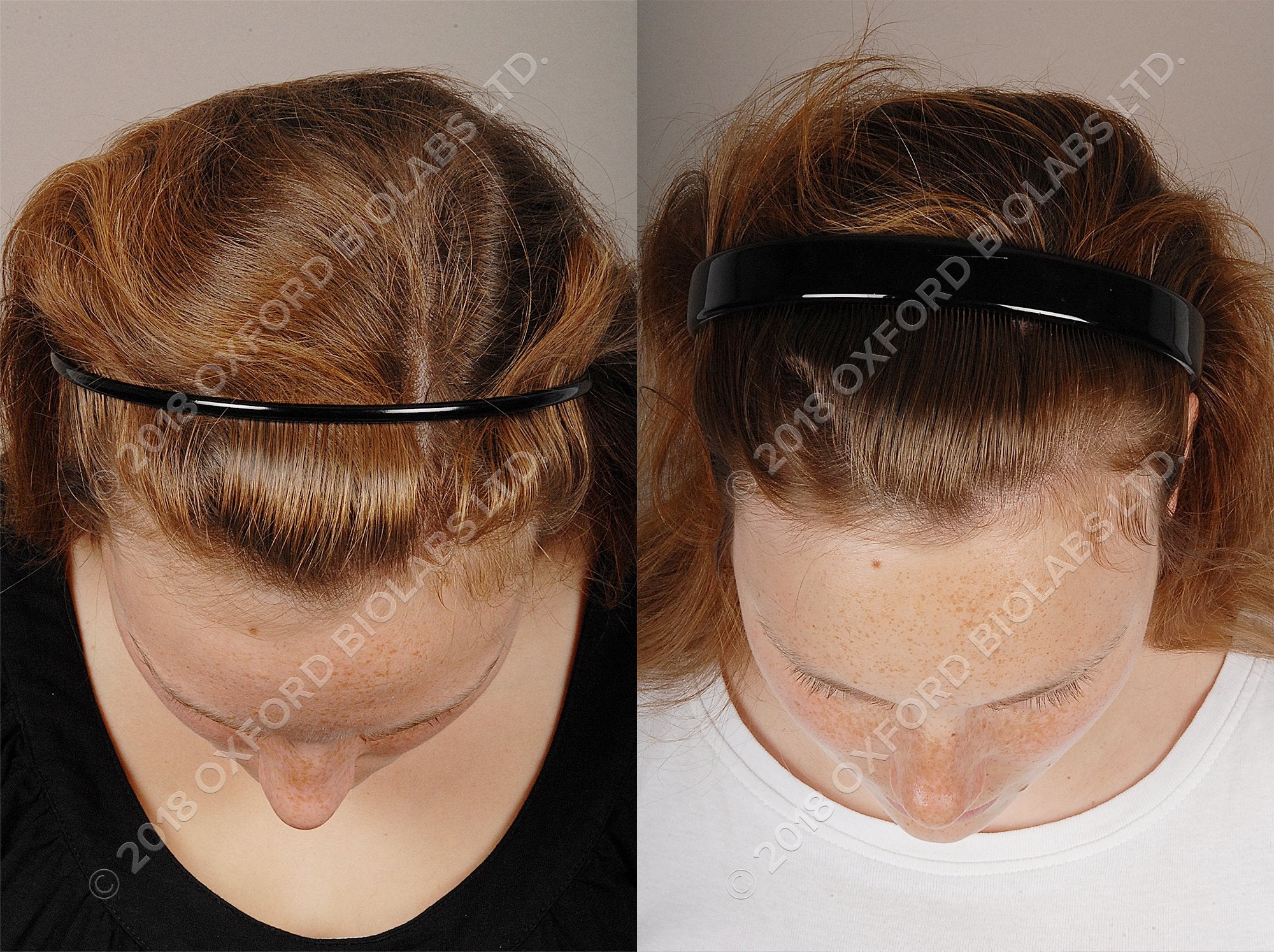 TRX2® Molecular Food Supplement for Hair - Oxford Biolabs